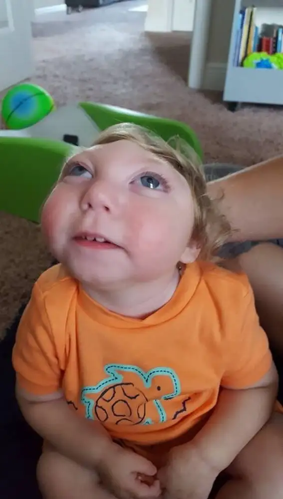 Muere Jaxon El Niño Que Nació Sin El 80 Del Cráneo