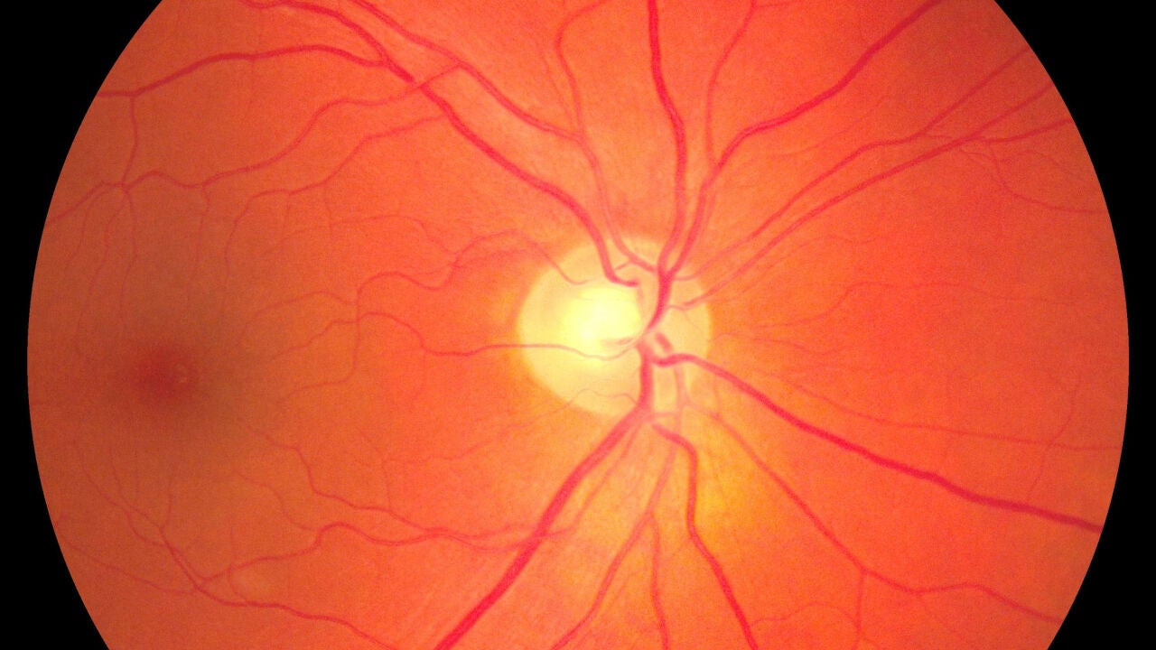 Así es el tratamiento más innovador frente a la pérdida de la visión ...