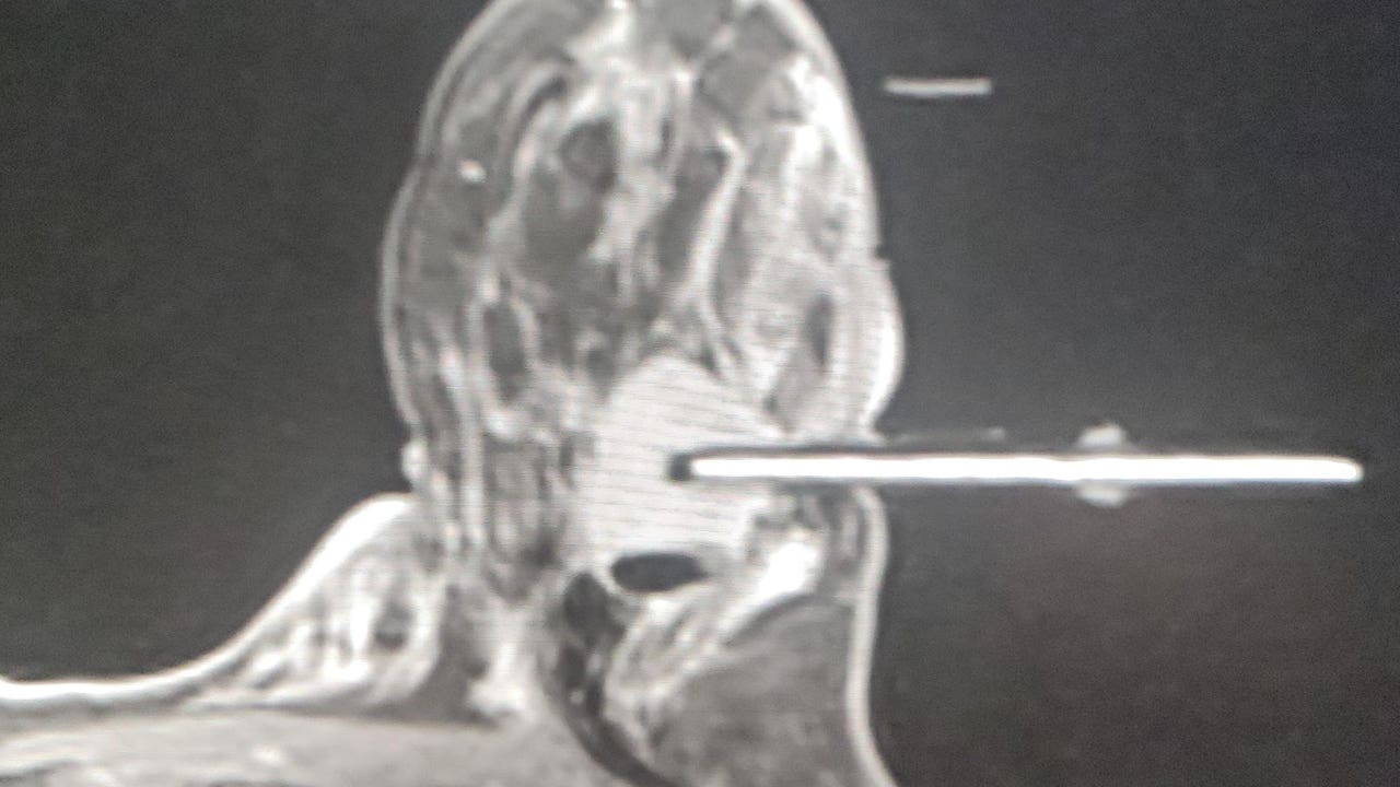 Así Se Realizan Las Biopsias Con Aguja De Vacío De Mama Guiada Con