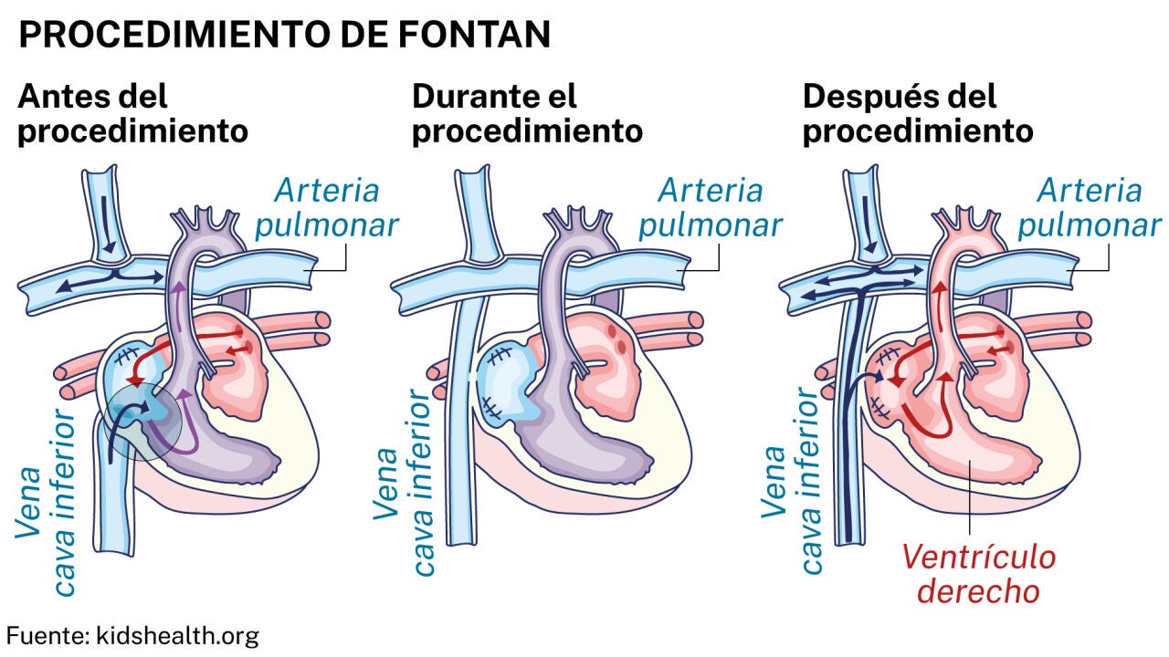Vinculan la cirugía de Fontan con cambios en el código genético