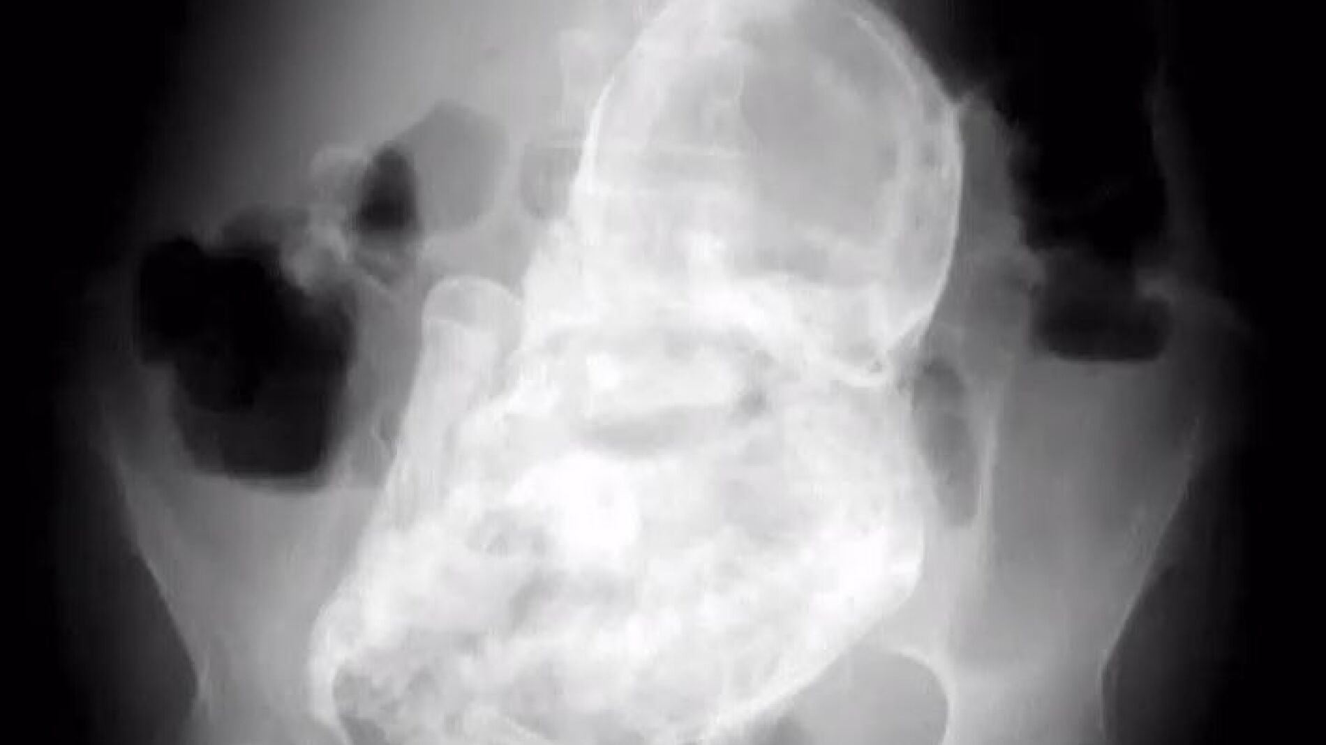 Hallan un feto calcificado hace 40 años en el vientre de una anciana