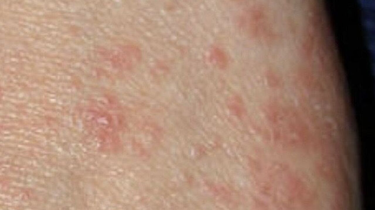 La sarna repunta con fuerza en España