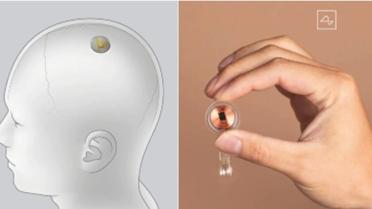 Así es el chip cerebral de Elon Musk: otro hito con más marketing que ...