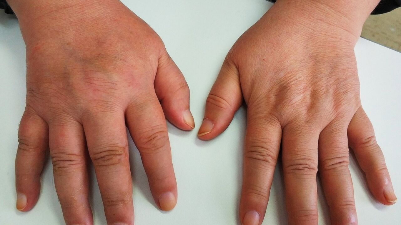 ¿Qué es y en qué consiste el Síndrome de Súdeck?